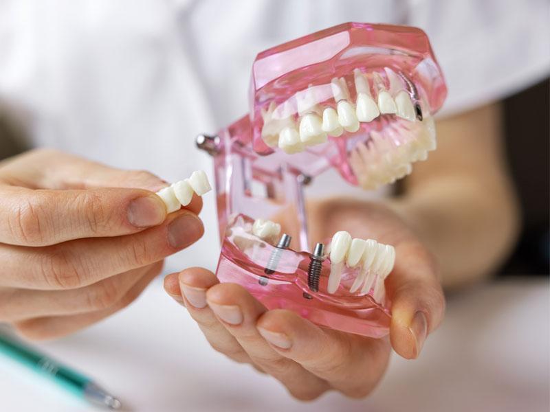 Dental Implants & Prosthetics | Mill Cove Dental Centre